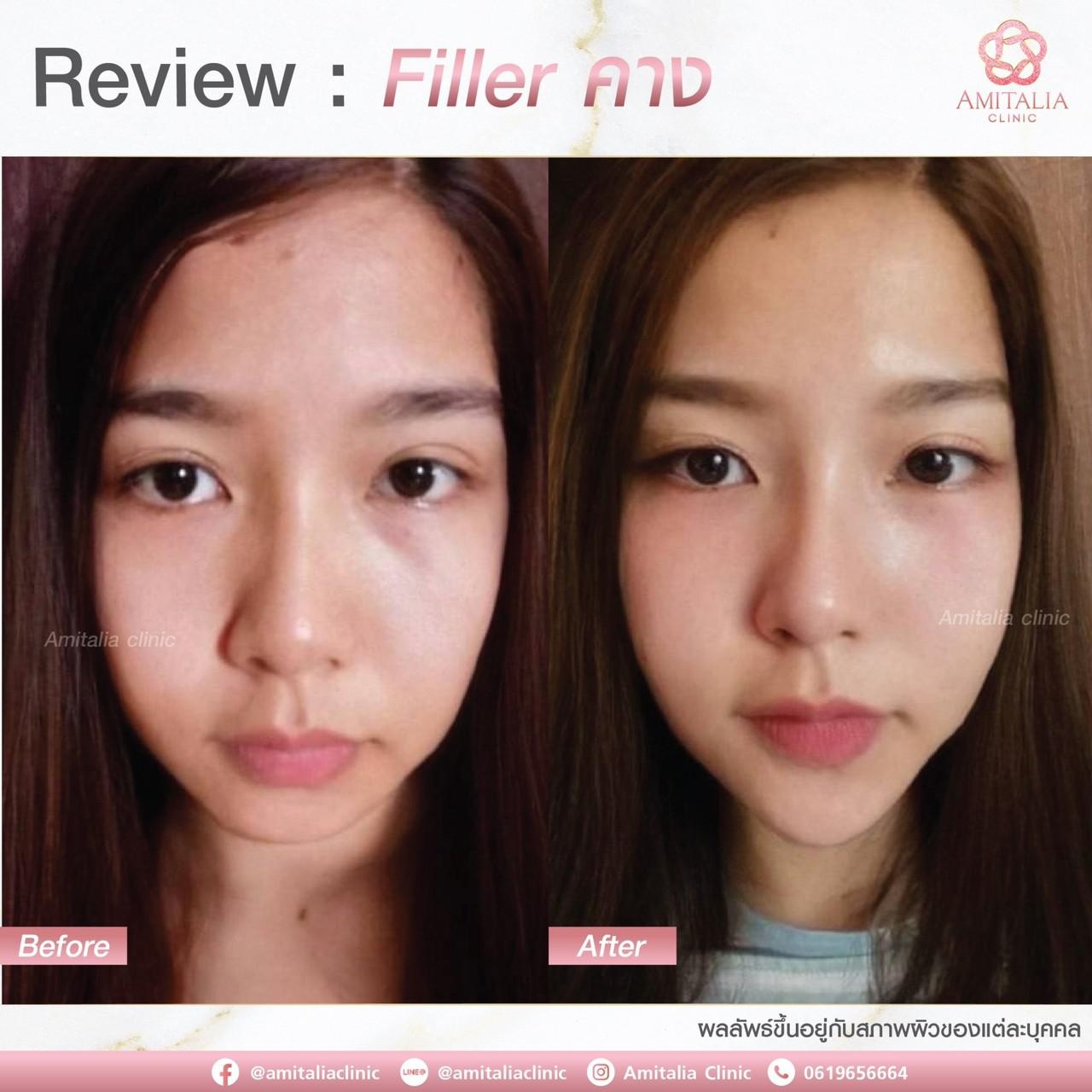 Review Filler คาง #3 - Amitalia clinic