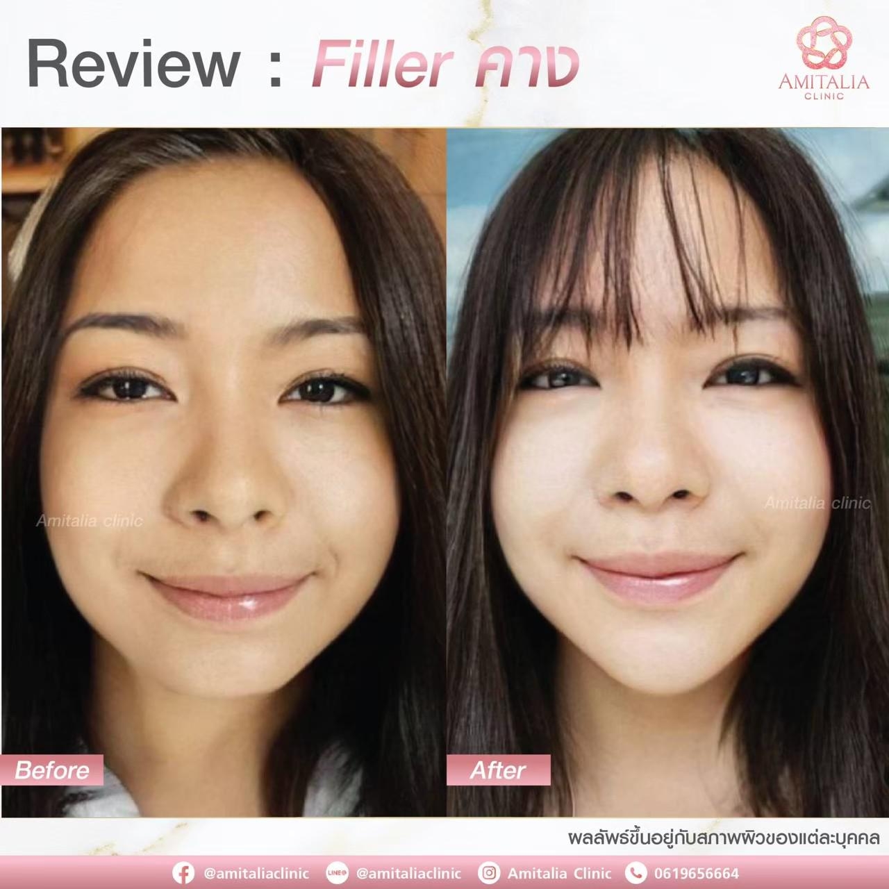 รีวิว Filler - Amitalia clinic