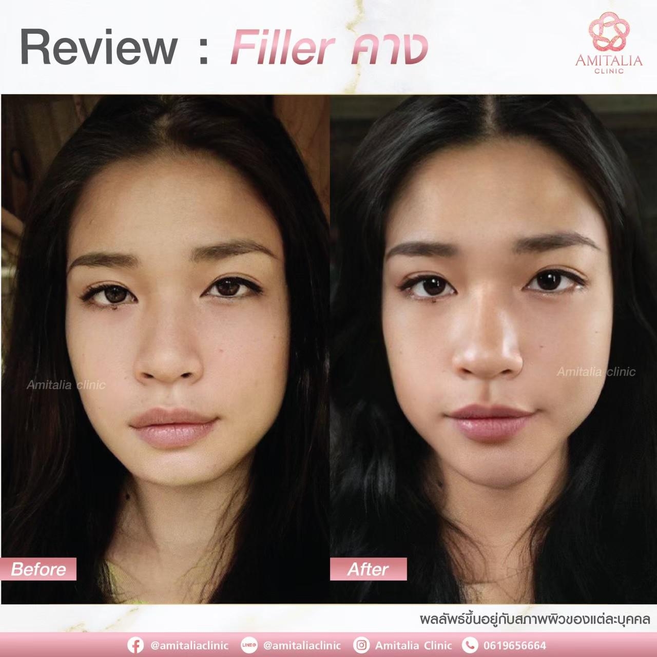 Review Filler คาง #7 - Amitalia clinic