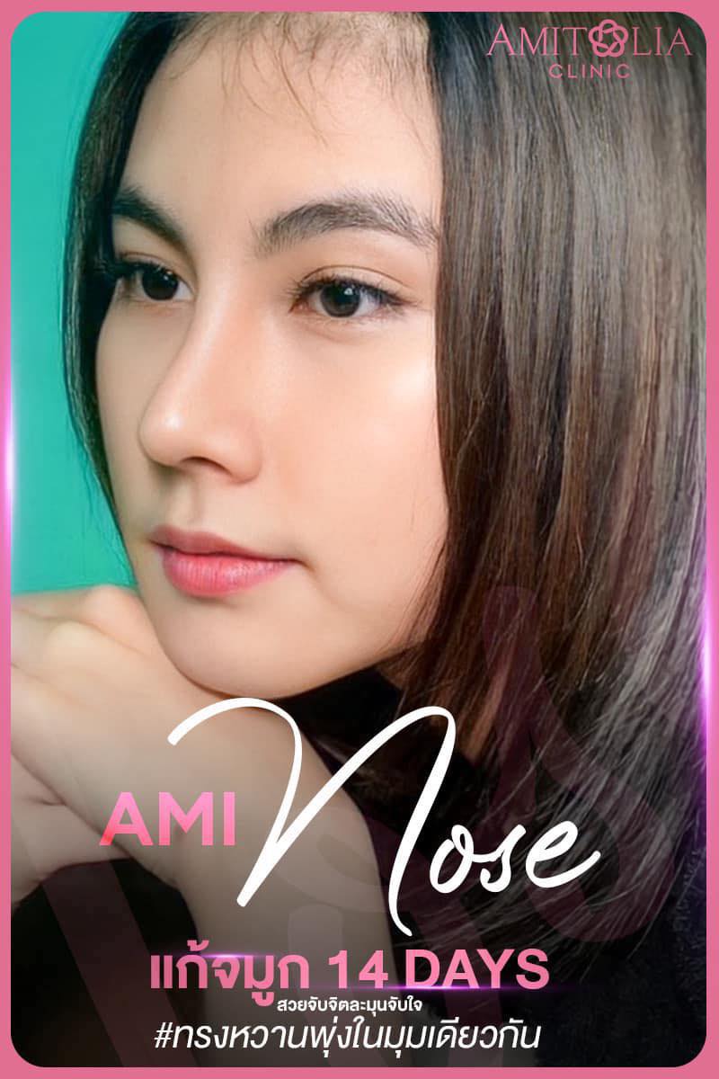 Review เสริมจมูก #103 - Amitalia clinic